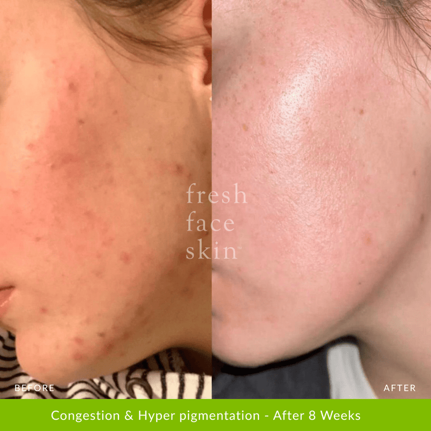 Suffering from Acne & underlining congestion - Fresh Face Skin