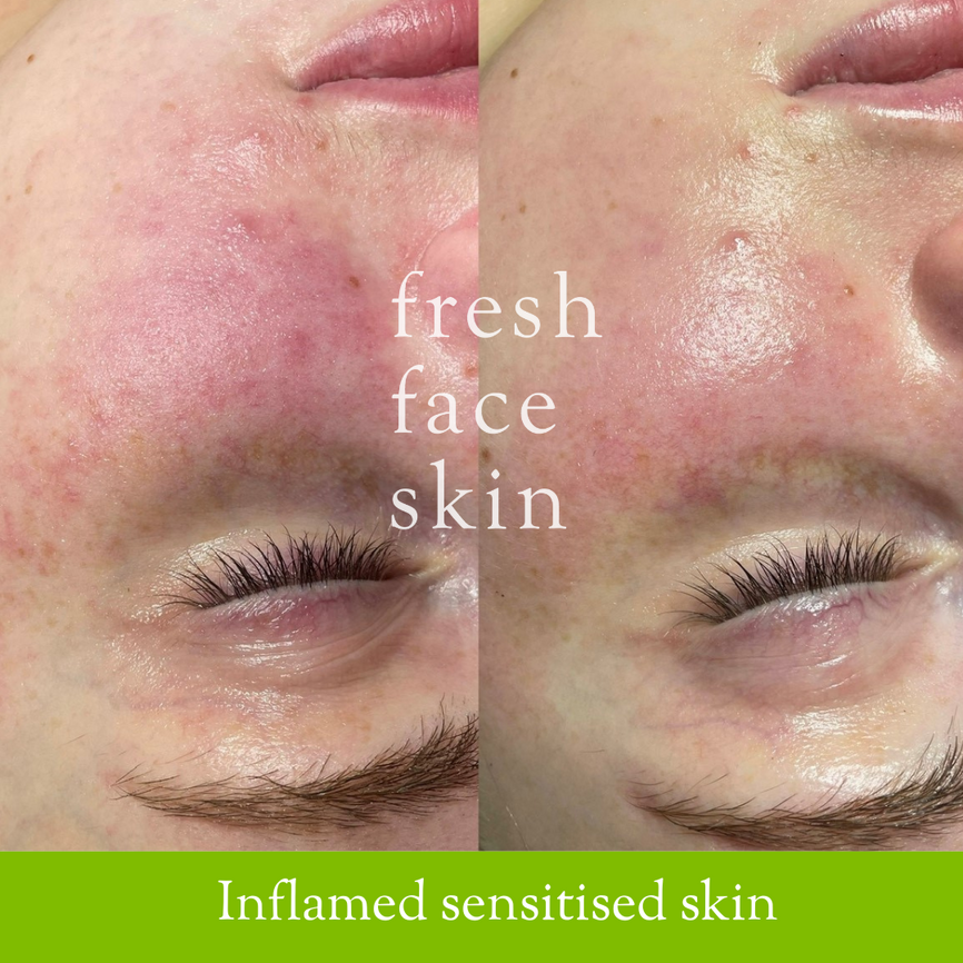 Skin Barrier Repair Pack | Strengthen & Protect Sensitive Skin ...