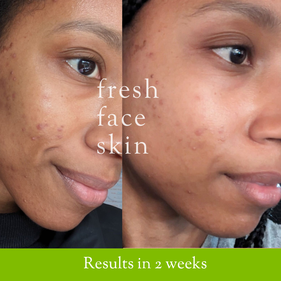 Fresh Face Healing Cleanser for acne, inflamed, oily skin. – Fresh Face ...